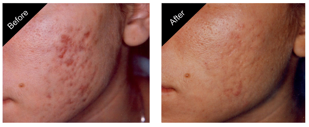 Acne Reduction Photos | Novalis Medical
