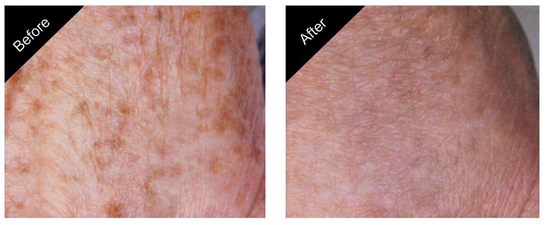 Skin Rejuvenation Before & After Photo | Novalis Medical