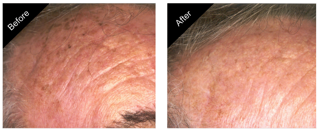 Skin Rejuvenation Before & After Photo | Novalis Medical