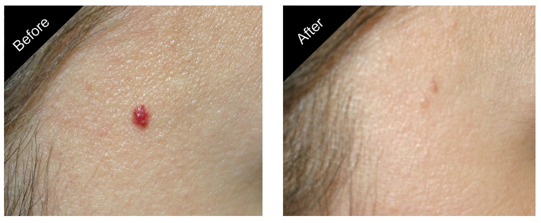 Angioma Removal Before & After Photo Gallery - Novalis Medical